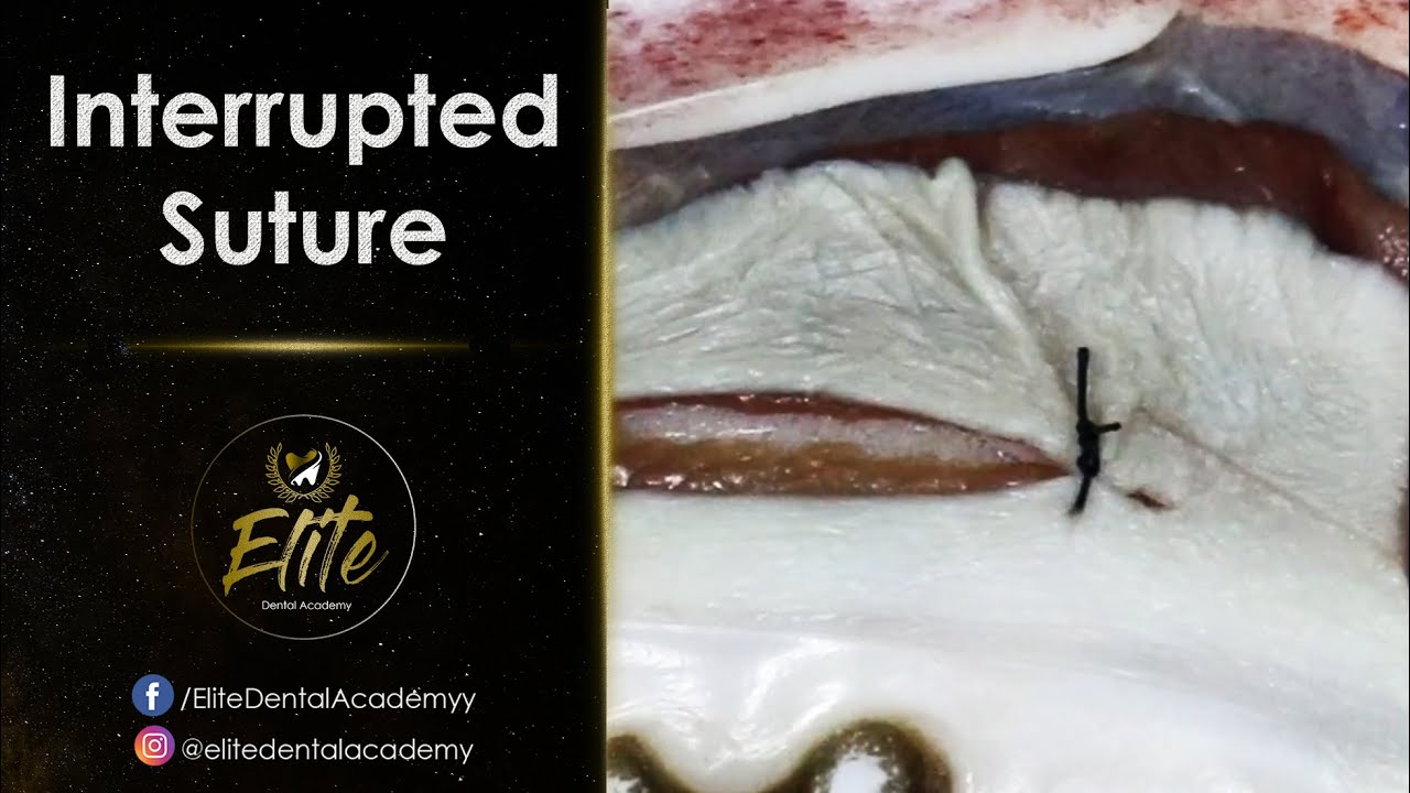 Interrupted Suture. - YouTube
