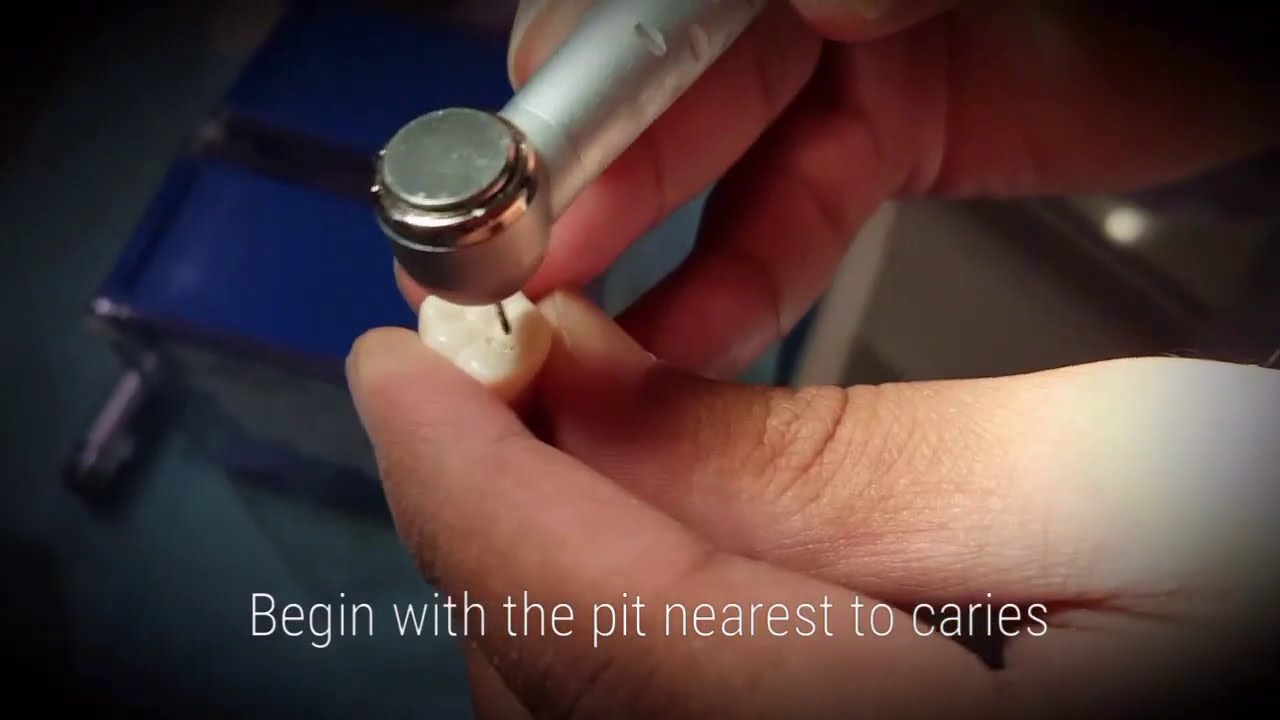 Class One Cavity Preparation! - YouTube