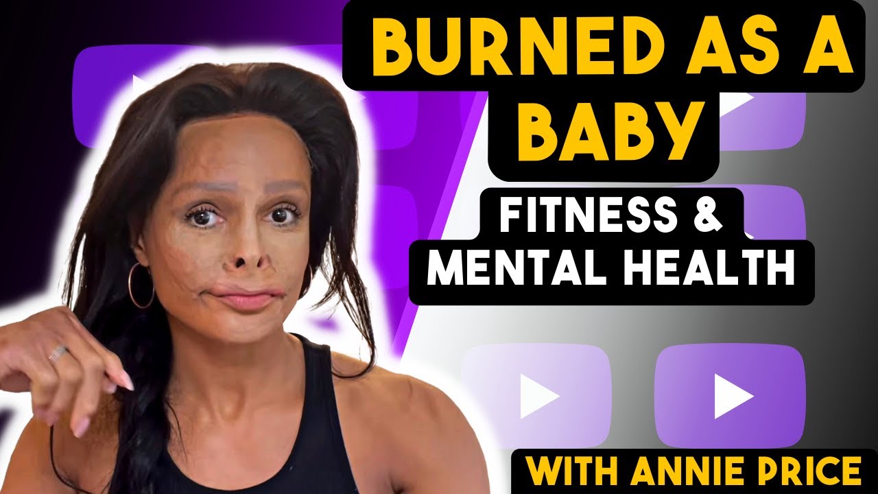 Burned as a Baby, Fitness, Mental Health with Annie Price | Azri ...