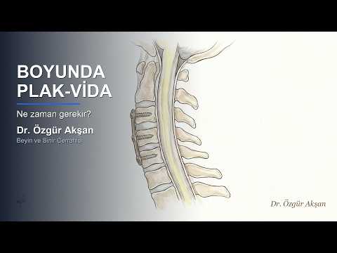 Boyun Fıtığında Plak Vida Ne Zaman Gerekir? | Dr. Özgür Akşan