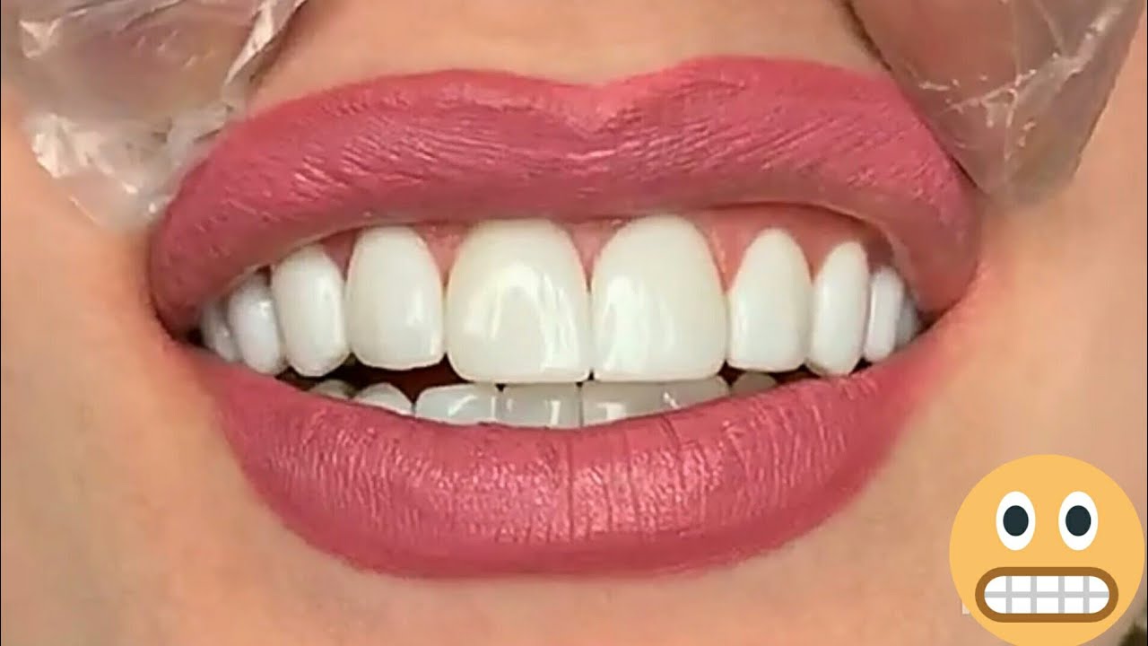 TEETH CLOSEUP TODAY | DENTIST ROOM - YouTube