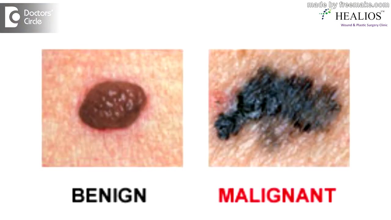 What is the risk of my child's birthmark becoming Skin Cancer in future ...