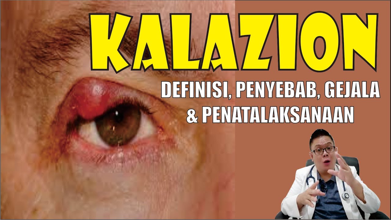 APA ITU KALAZION ?................. APAKAH KELAINAN INI BISA ...