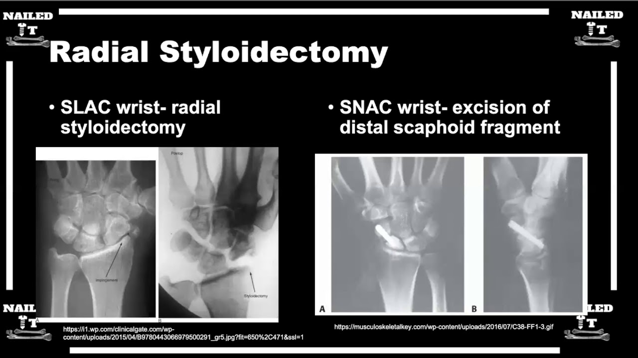 Treatment of Stage 1 SLAC wrist - YouTube