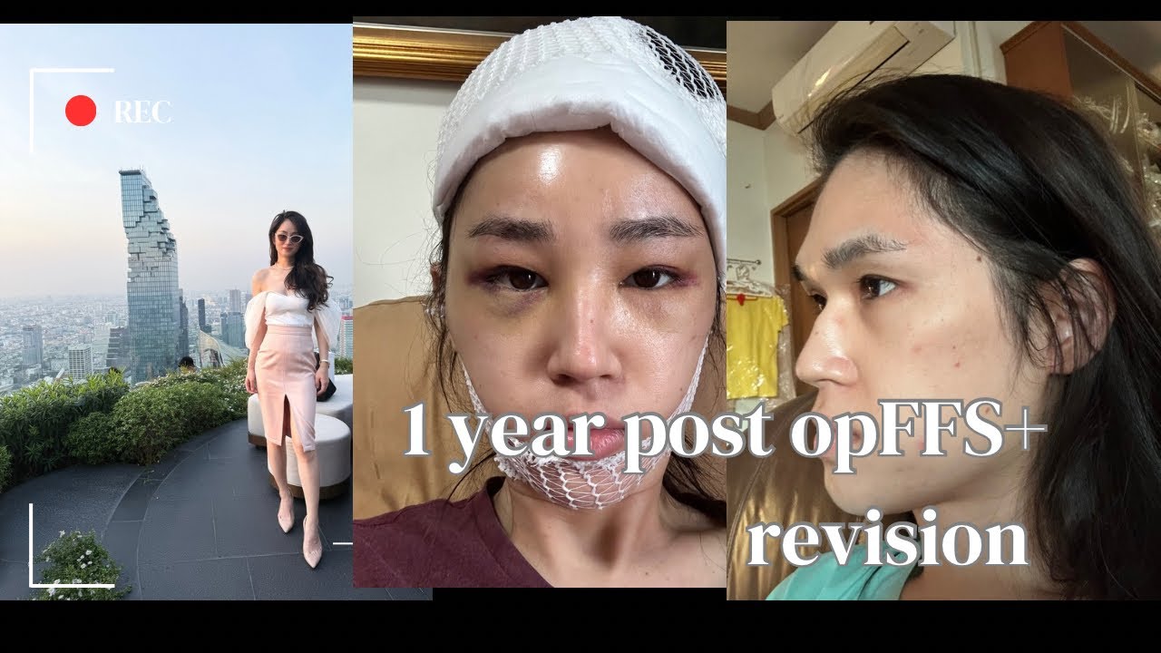 One year post op ffs forehead and revision plan - YouTube
