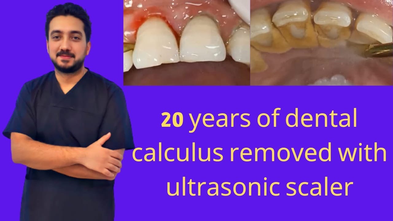 20 Years of Dental Calculus Removed with Ultrasonic Scaler ( Full ...