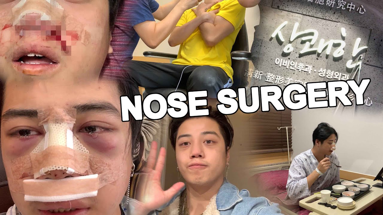 My Nose Surgery (using rib bone) and the Recovery Process - YouTube
