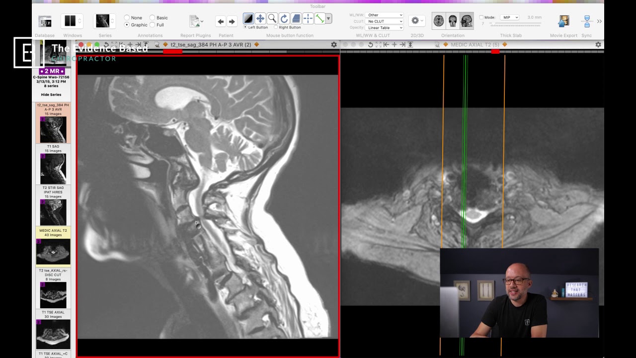 LIVE MRI Review of a Complex Cervical Fusion: Key Evaluation Points ...