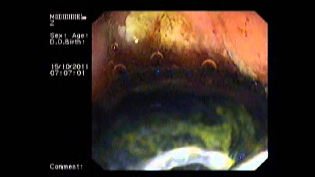 CBD stone removal - YouTube