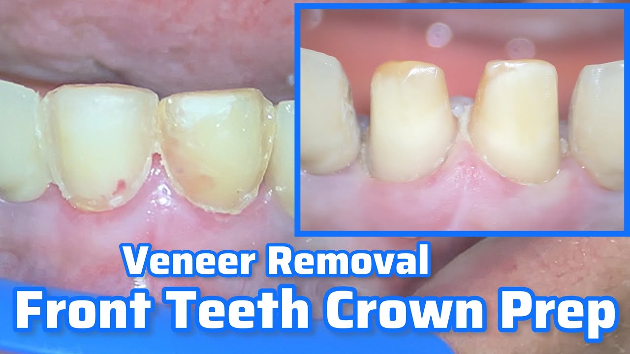 Removing Old Veneers & Preparing Crowns on Front Teeth | Real Dentist ...