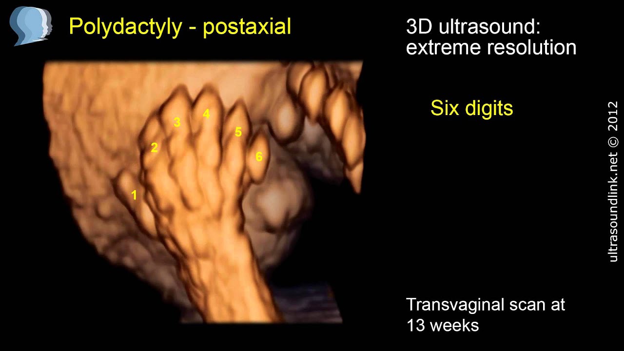 Polydactyly: 3D ultrasound amazing resolution - YouTube