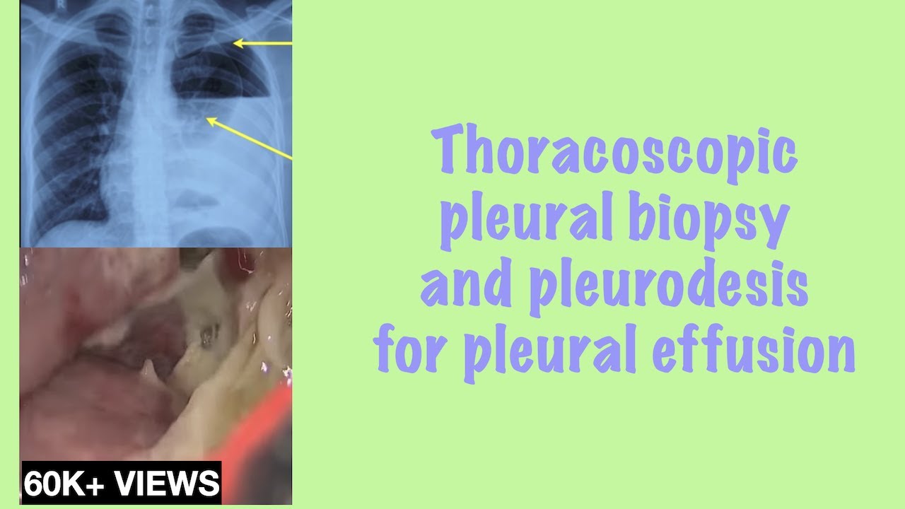 Thoracoscopic (VATS) pleural biopsy and pleurodesis for pleural ...