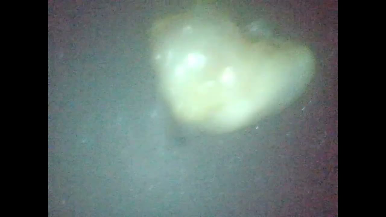 GIANT BOOGER Pulled From Nose Patient Cant Breathe! - YouTube