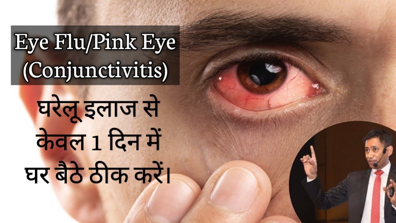 Eye Flu/Pink Eye (Conjunctivitis) बिना दवाई घर बैठे एक ही दिन में ठीक ...