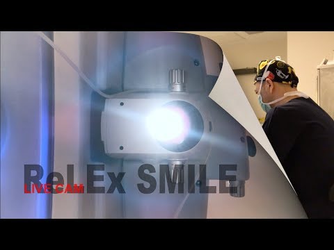 Canlı SMiLE Lazer göz çizdirme deneyimi