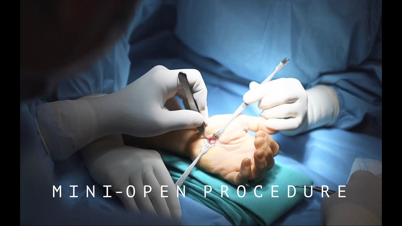 Carpal Tunnel: Mini-Open Procedure - YouTube