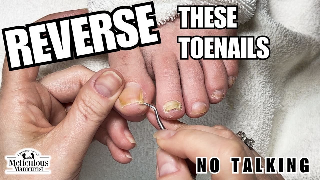 👣Damaged Toenails Pedicure - No Talking👣 - YouTube