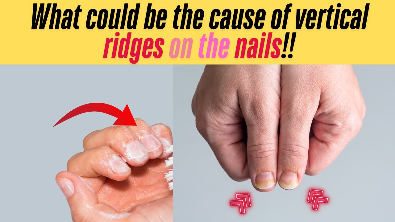 Causes and Treatments for Vertical Ridges on Nails That You Shouldn't ...