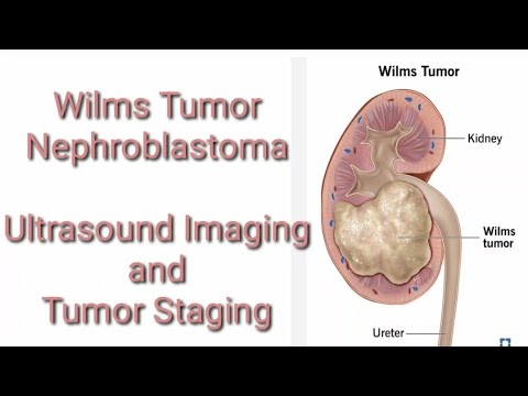 Wilms Tumour. Nephroblastoma Ultrasound Imaging and tumor Staging - YouTube