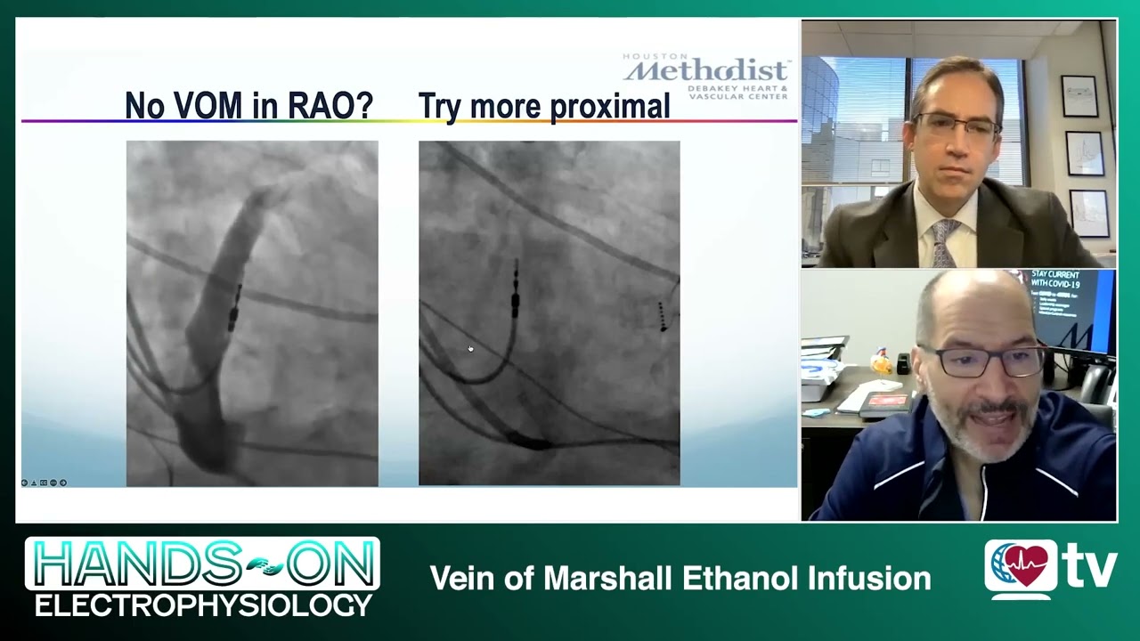 Hands-On Electrophysiology: Vein of Marshall Ethanol Infusion - YouTube