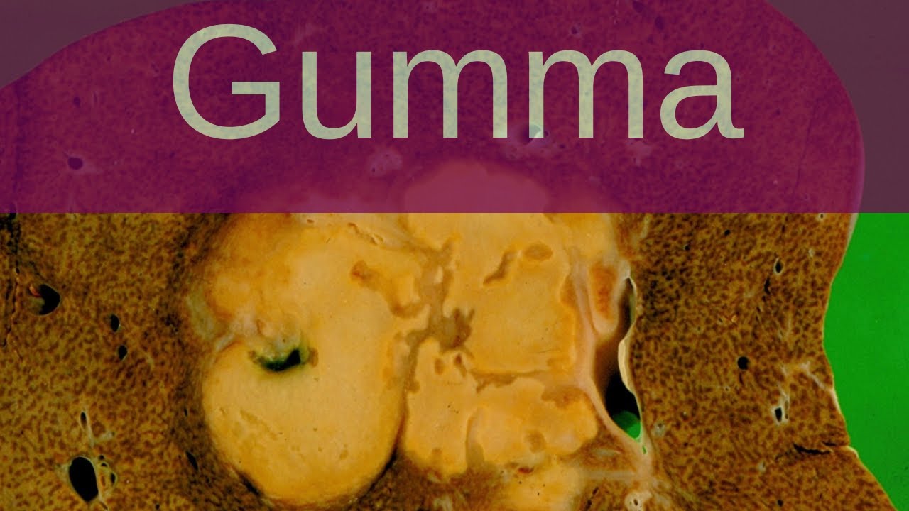 What is a Gumma? - Pathology mini tutorials - YouTube