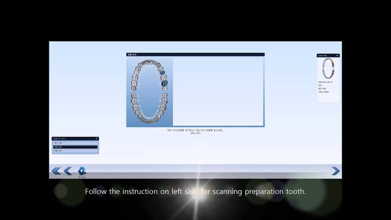 IDENTICA BLUE bridge with bite impression - YouTube