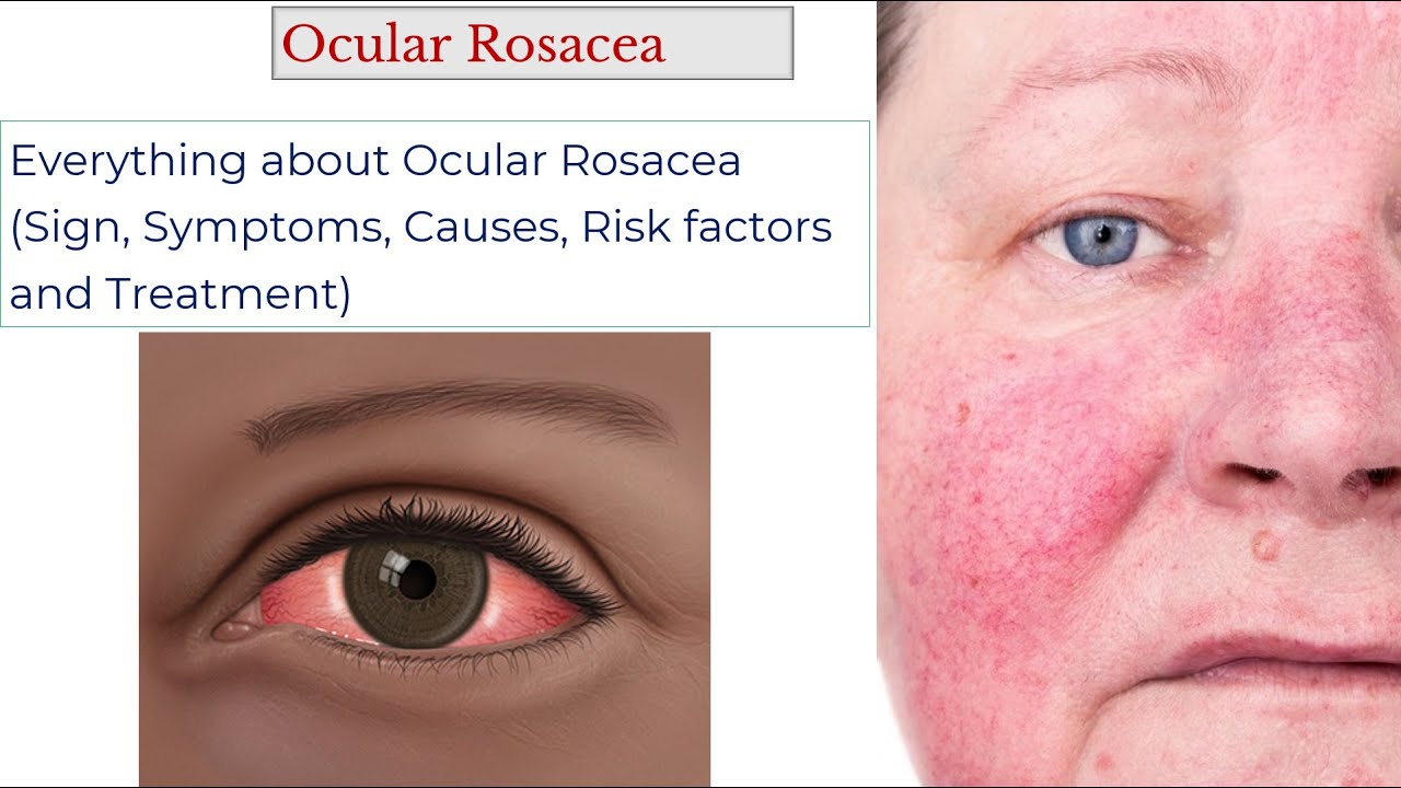 Ocular Rosacea- Sign, Symptoms, Risk factors and treatment - YouTube