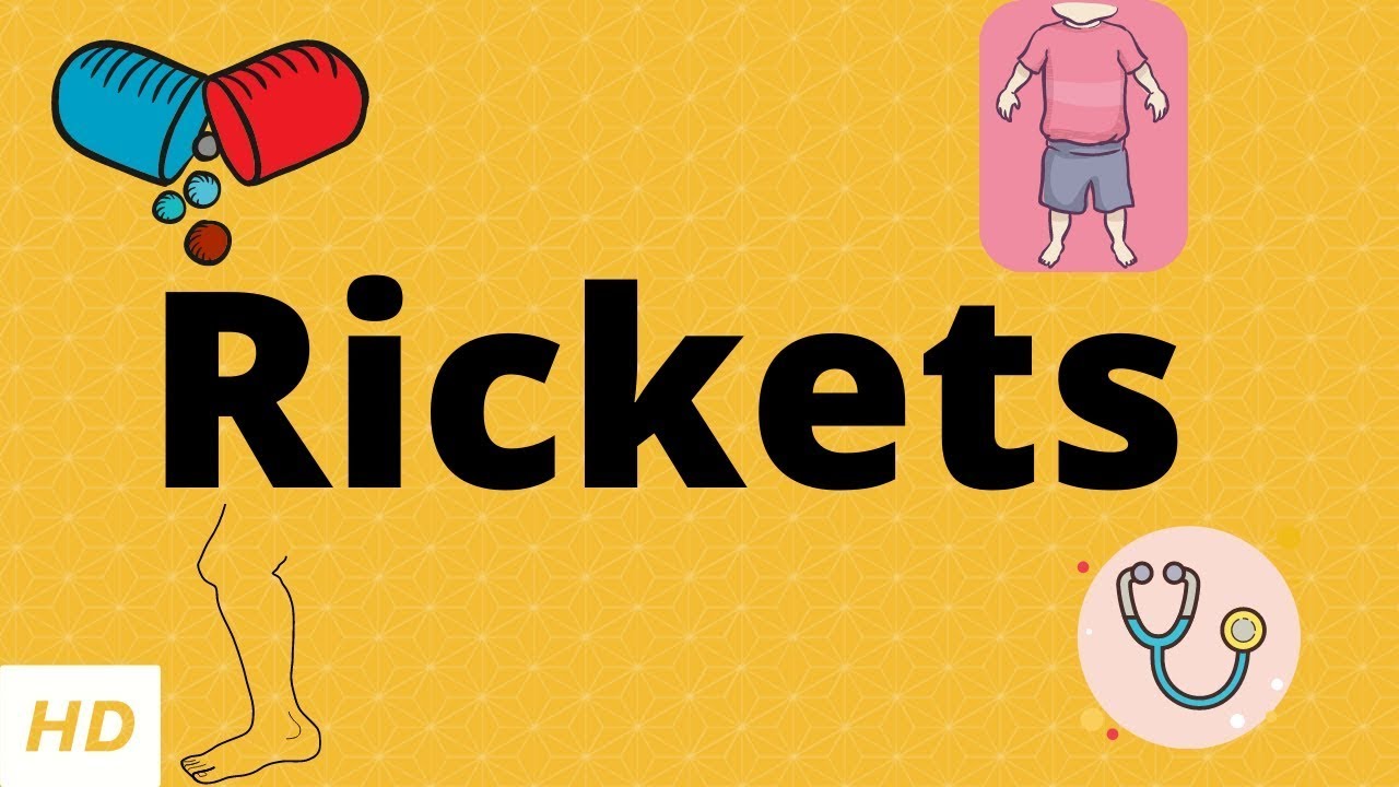 Rickets, Causes, Signs and Symptoms, Diagnosis and Treatment. - YouTube