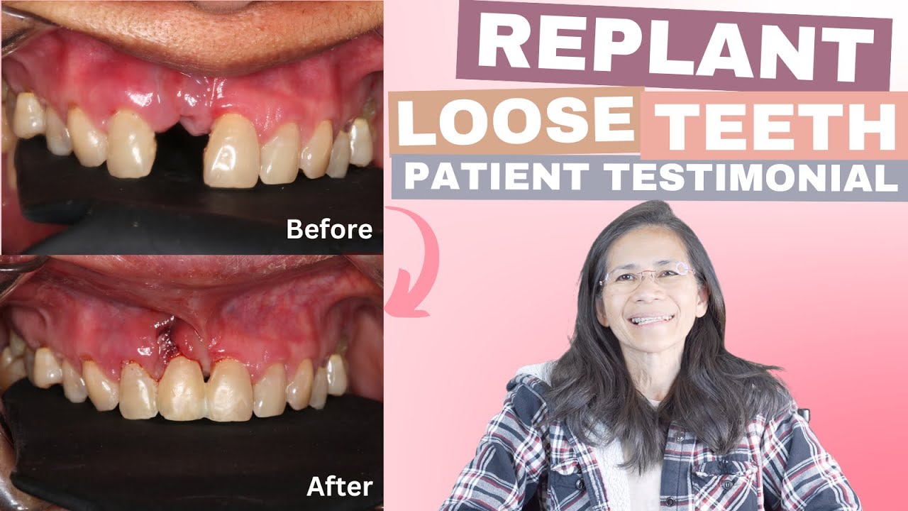 Patient Success Story: The Incredible Replanting of A Loose Tooth - YouTube