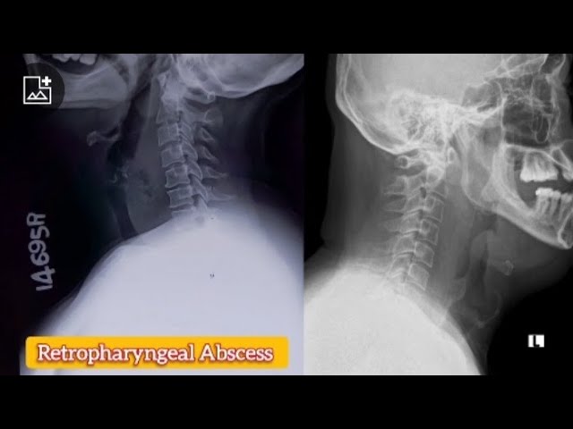 Retropharyngeal Abscess Lateral Neck X Ray Radiology In Ped Emerg Med,
