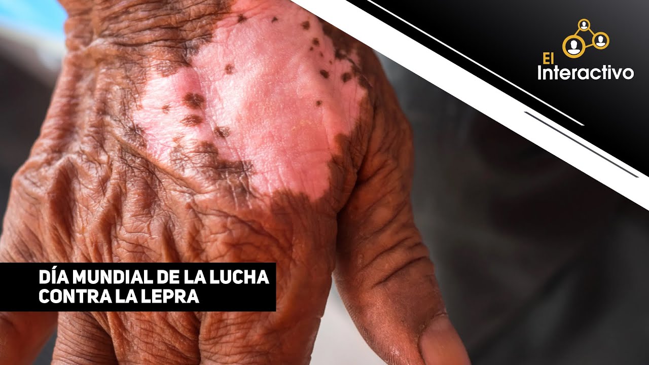 La lepra en el siglo XXI: Una enfermedad curable pero aún presente ...