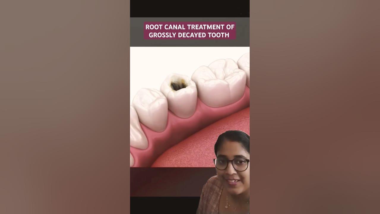 ROOT CANAL TREATMENT IN GROSSLY DECAYED TOOTH #shortsfeed #dental #dentalcare #youtubeshorts # ...