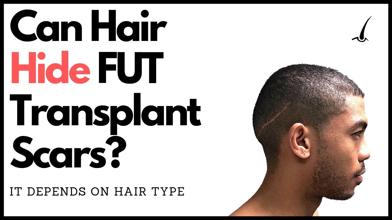 Can You Hide Your Hair Transplant Scar The TRUTH Hiding Hair can-you-hide-your-hair-transplant-scar-the-truth-hiding-hair