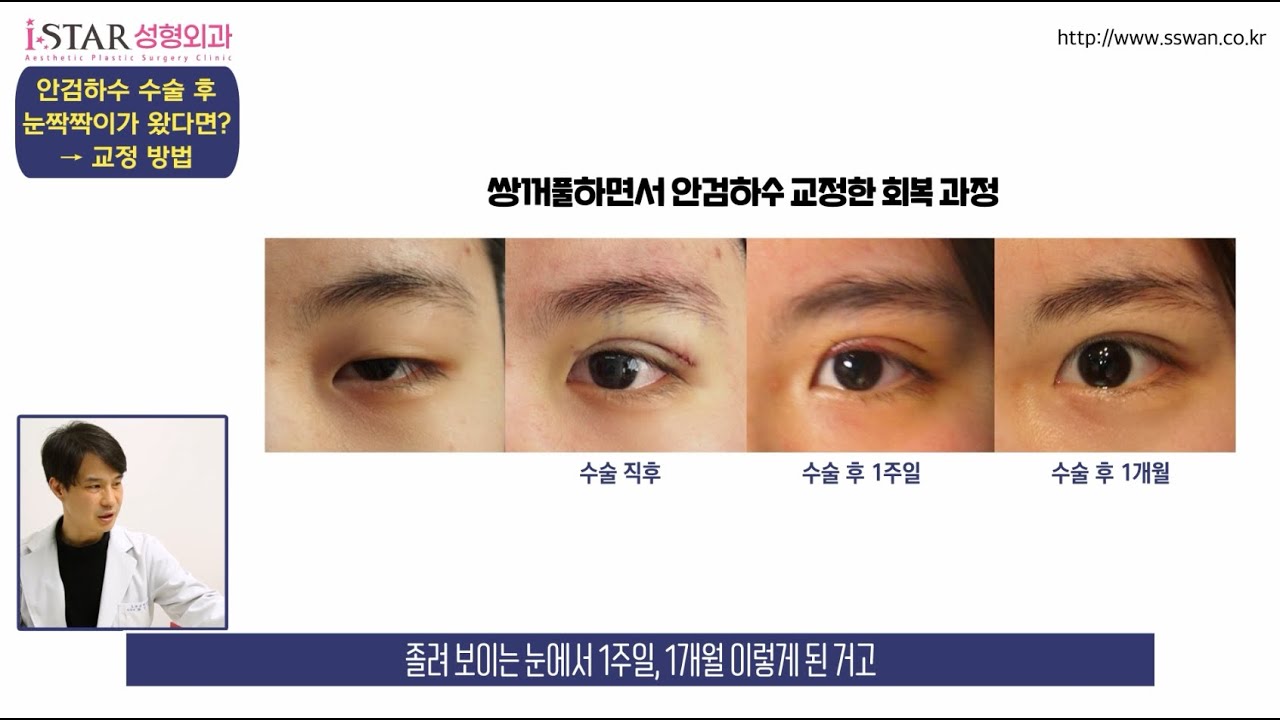 안검하수 눈 특징부터 알고가자 안검하수로 인해 쌍꺼풀 꺾임 눈짝짝이 소세지눈 ⭐내부교정⭐이 중요 올바른 내부교정으로 개선된 사례🎬 Youtube