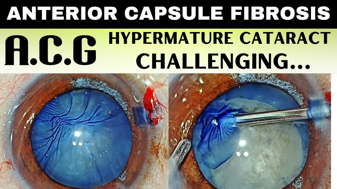 Anterior capsule fibrosis, Hypermature cataract; Angle closure glaucoma ...