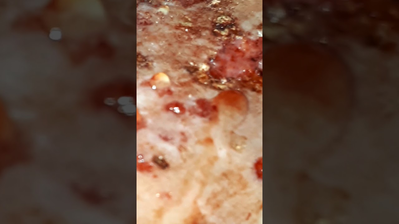 Tungiasis Severa y Transmisión 1 - YouTube