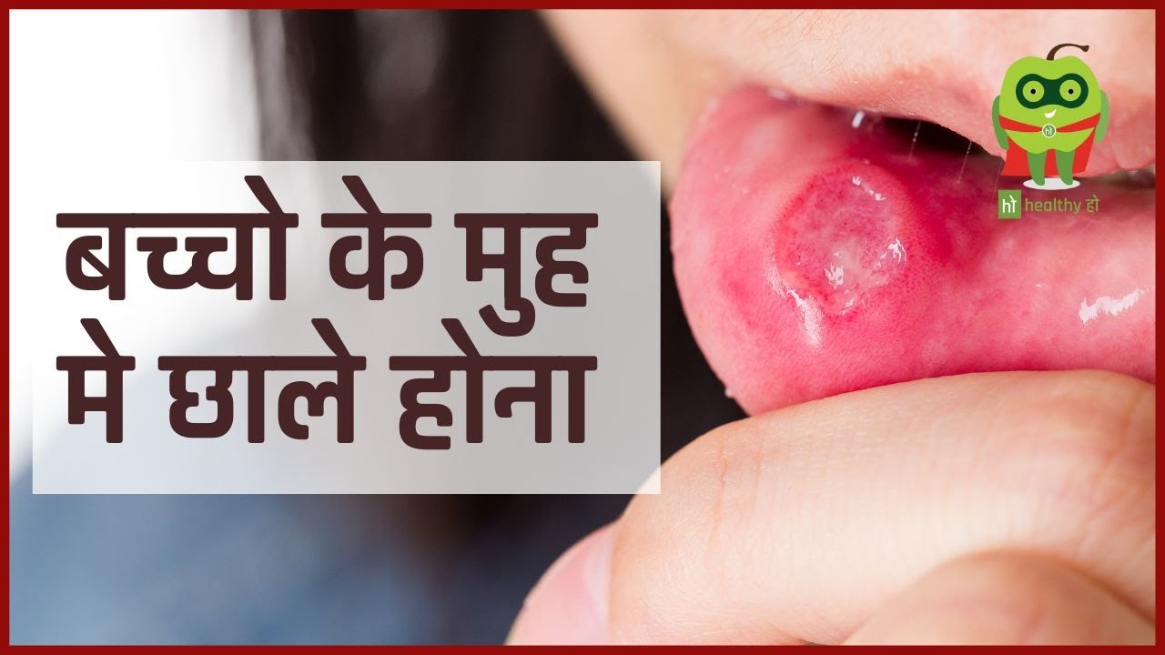 Mouth Ulcers In children | बच्चो के मुह मे छाले | #healthyho - YouTube