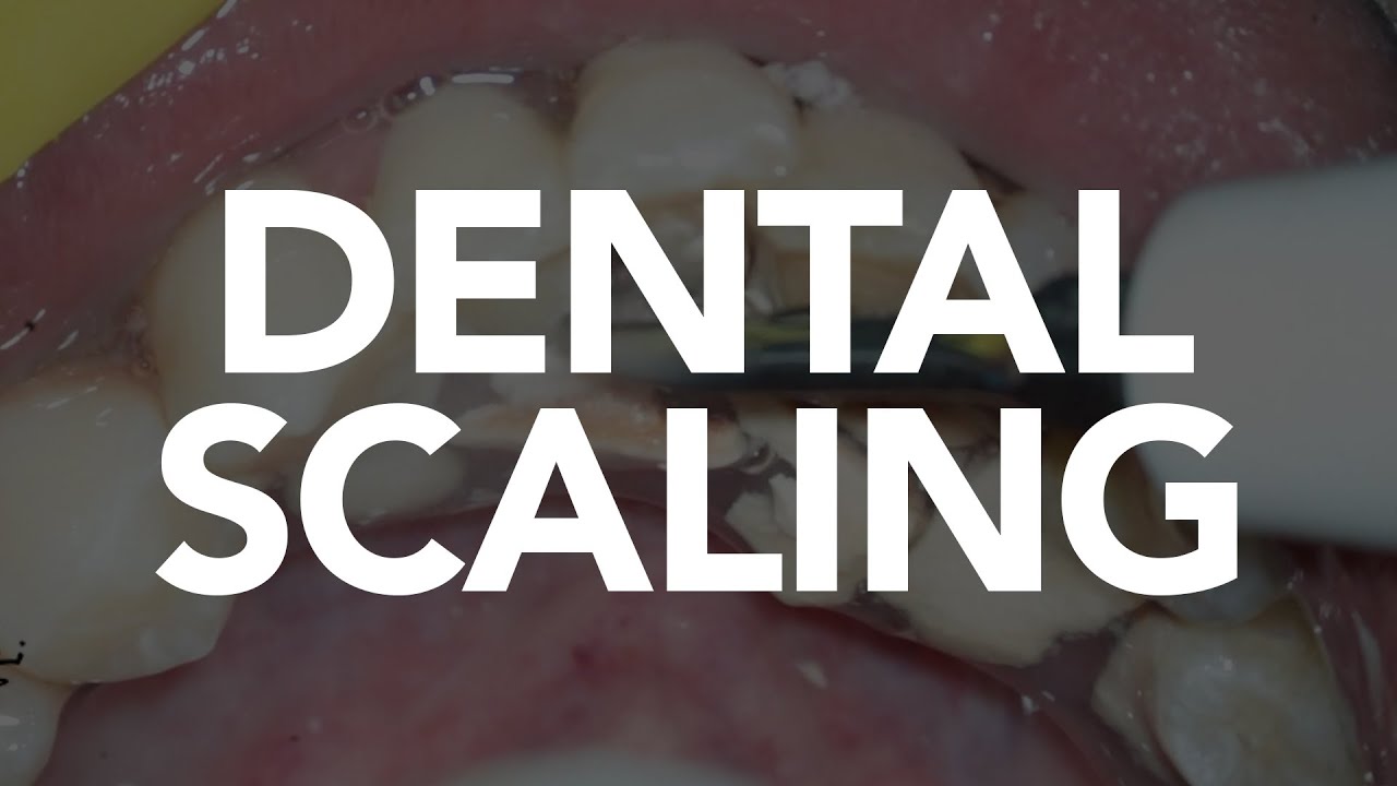 Scaling - Removal of calculus on the lower anterior tooth - YouTube