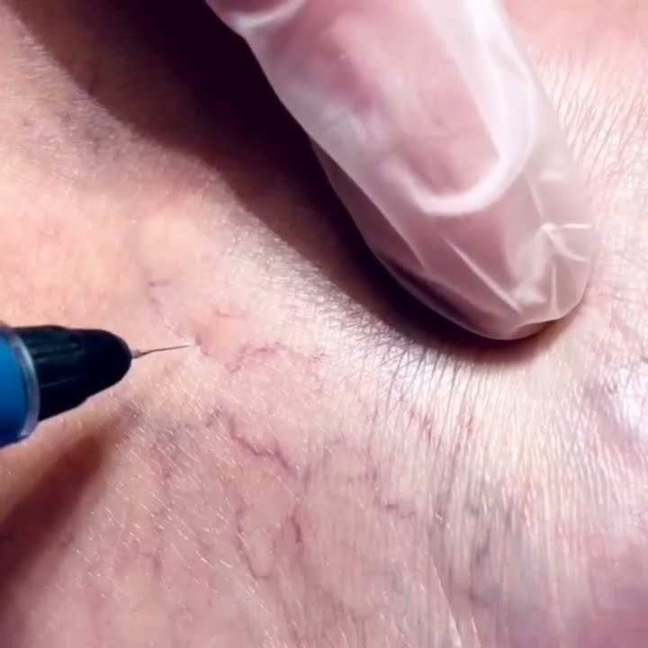 VeinGogh treatment - YouTube