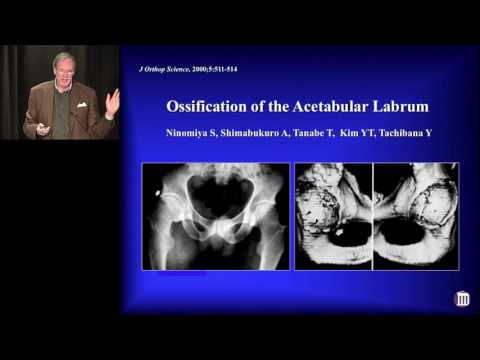 What Is Acetabular Labral Ossification
