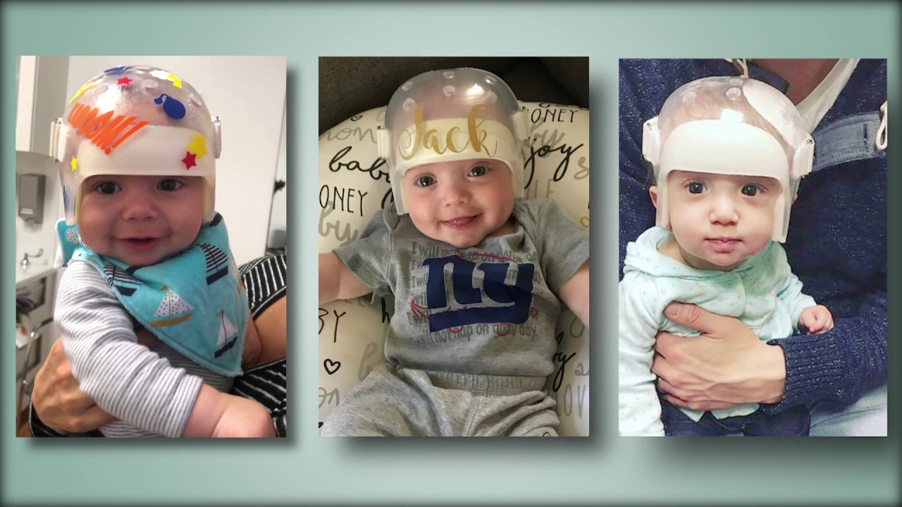 Craniosynostosis Helmet