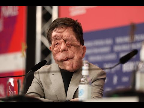 Adam Pearson: Disfigured Berlinale star wows at premiere - YouTube
