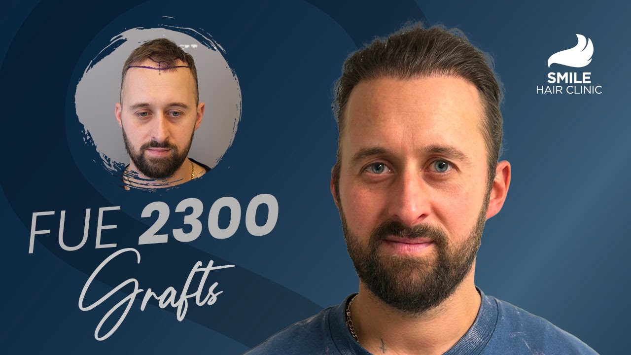 12-Month Transformation with 2300 Grafts | Hair Transplant Before ...
