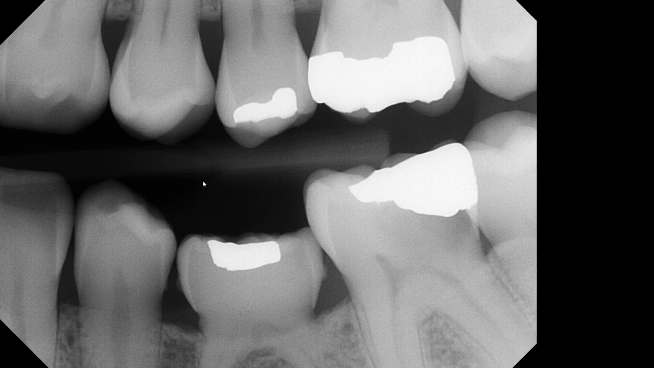 Ankylosed primary molars, congenitally missing premolar - YouTube