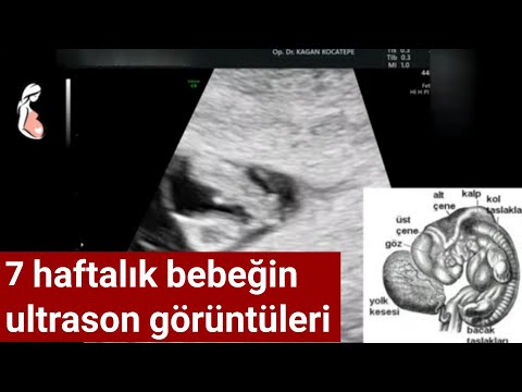7 haftalık gebelikte bebek ultrason görüntüleri, gebelik kesesi, yolk kesesi ve kalp atışları