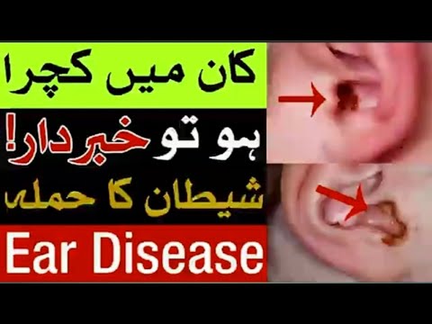 If there is garbage in the ear, be careful! Attack of Satan - YouTube