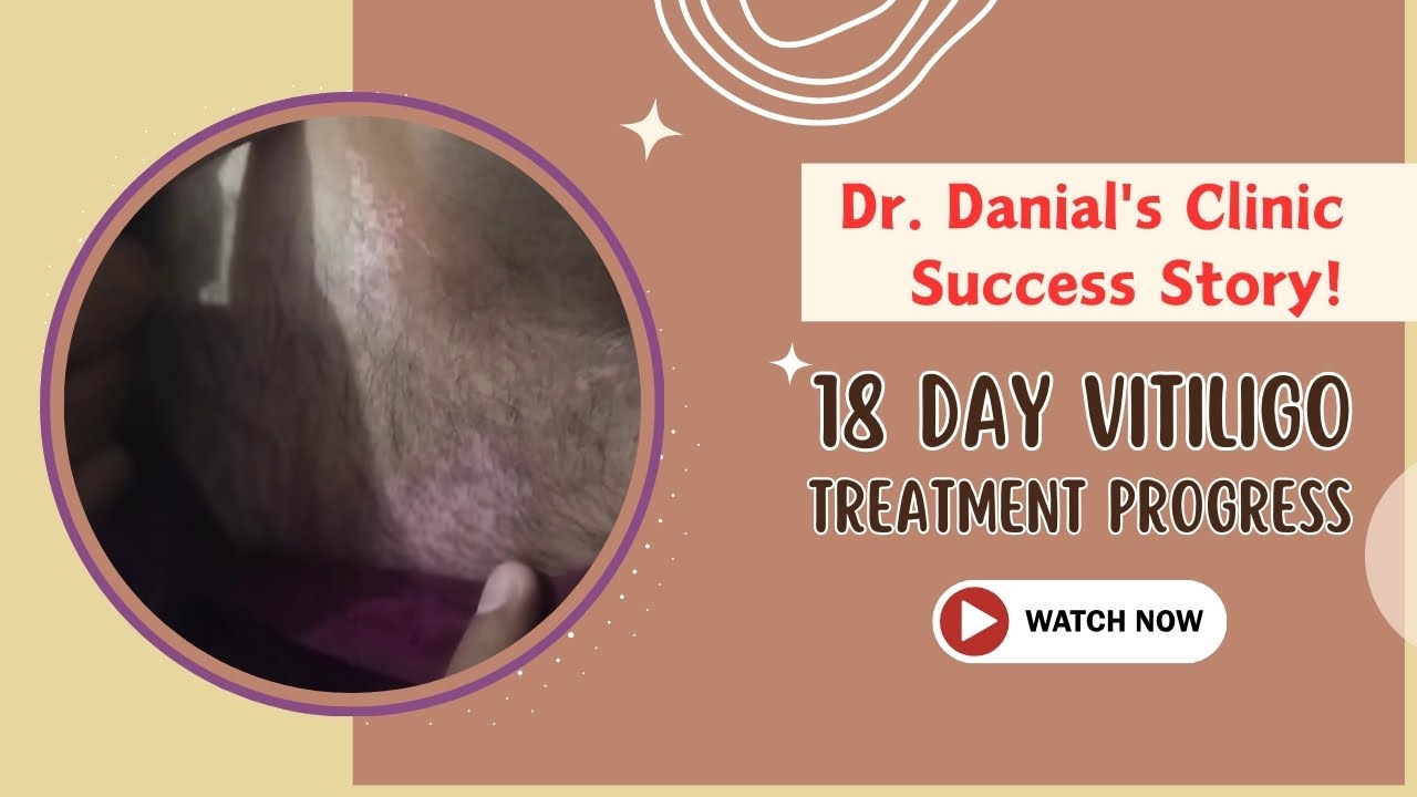 18 Days Unveiling Incredible Vitiligo Treatment Progress | # ...