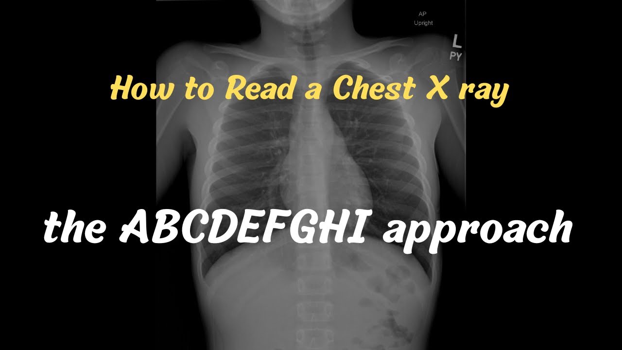 How to read a Chest X ray | the ABCDEFGHI approach | a guide for ...