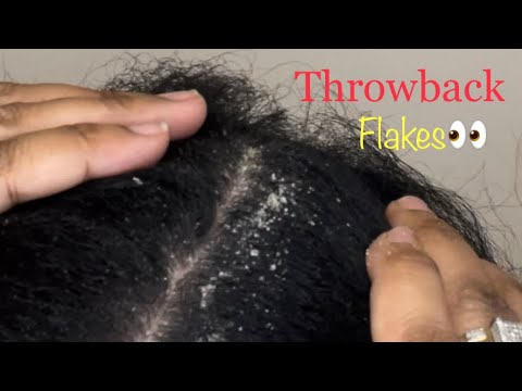 {ASMR} Dandruff Scratching Lots of Crusty Dandruff Flakes (Compilation ...