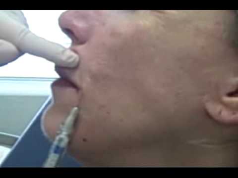 Basic Injection Techniques for Fillers - YouTube